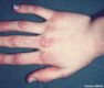 Dermatomyositis - The Myositis Association