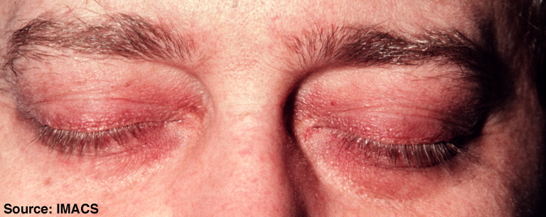 Dermatomyositis - The Myositis Association